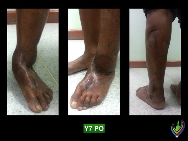 Distally-Based Sural Flap | PDF