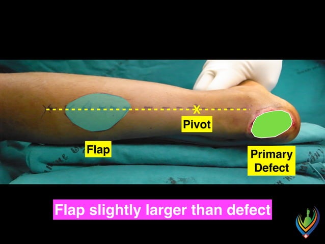 Distally-Based Sural Flap | PPT