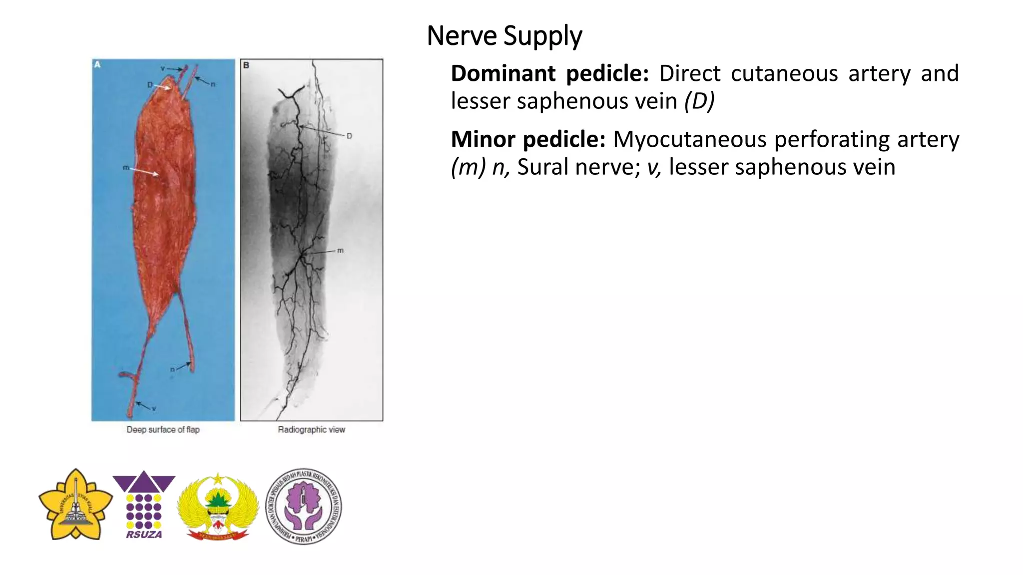 sural flap.pptx