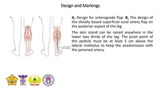sural flap.pptx