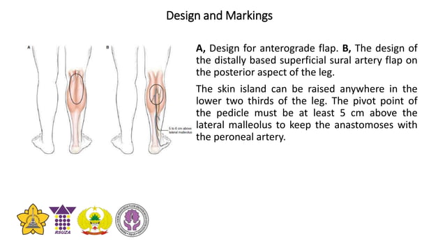 sural flap.pptx