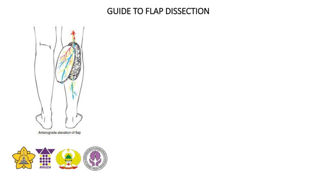 sural flap.pptx