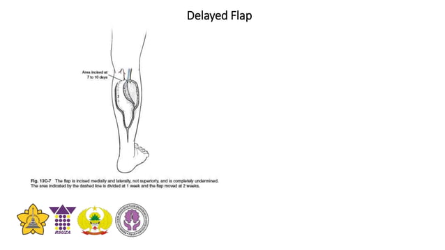 sural flap.pptx