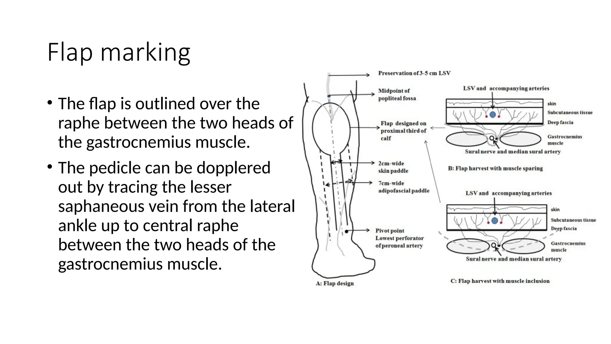 distally based sural artery flap for reconstruction of lower limb flap ...
