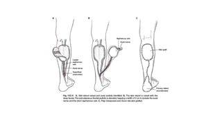distally based sural artery flap for reconstruction of lower limb flap ...