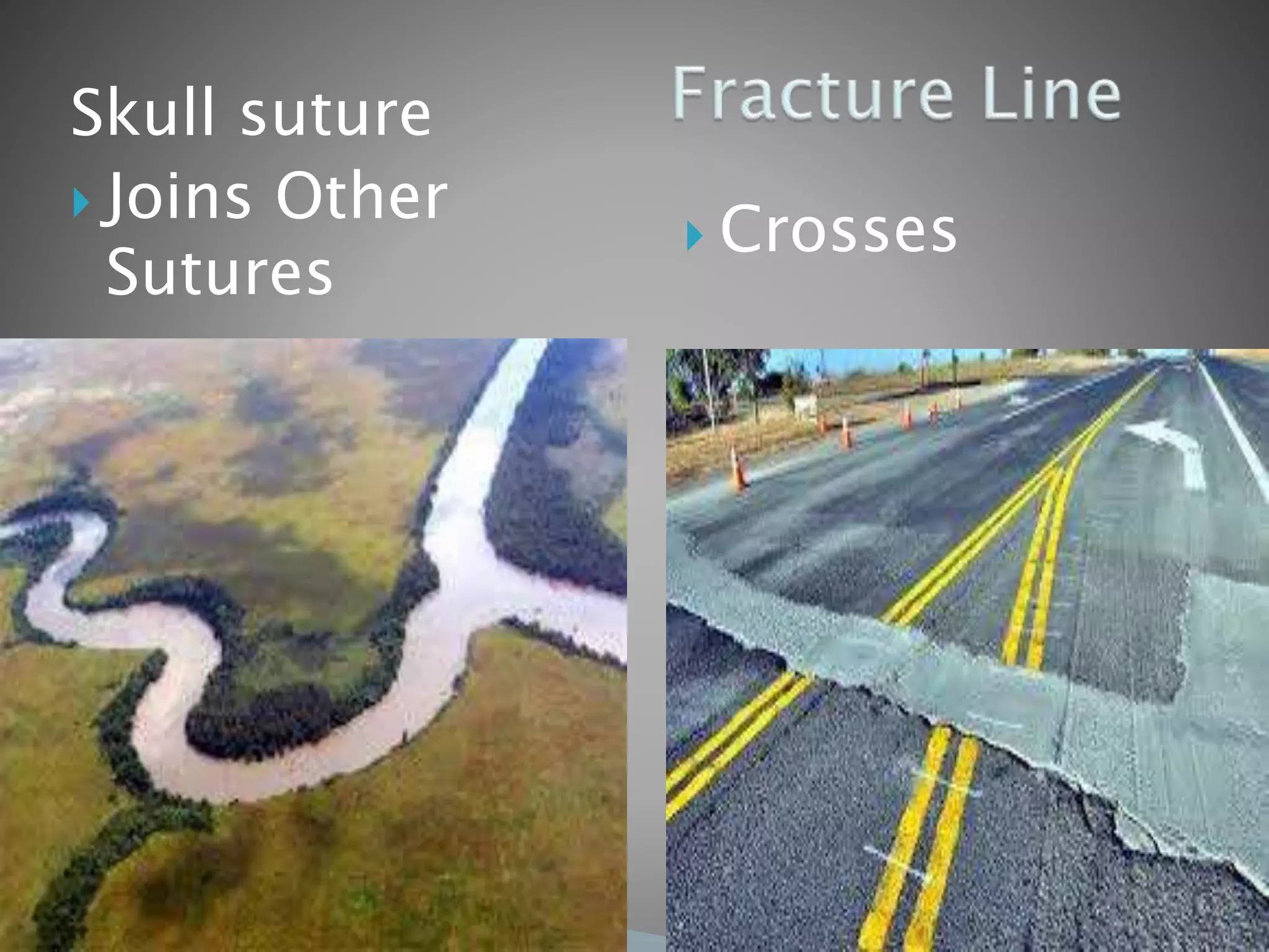 skull fractures vs accessory sutures | PPTX