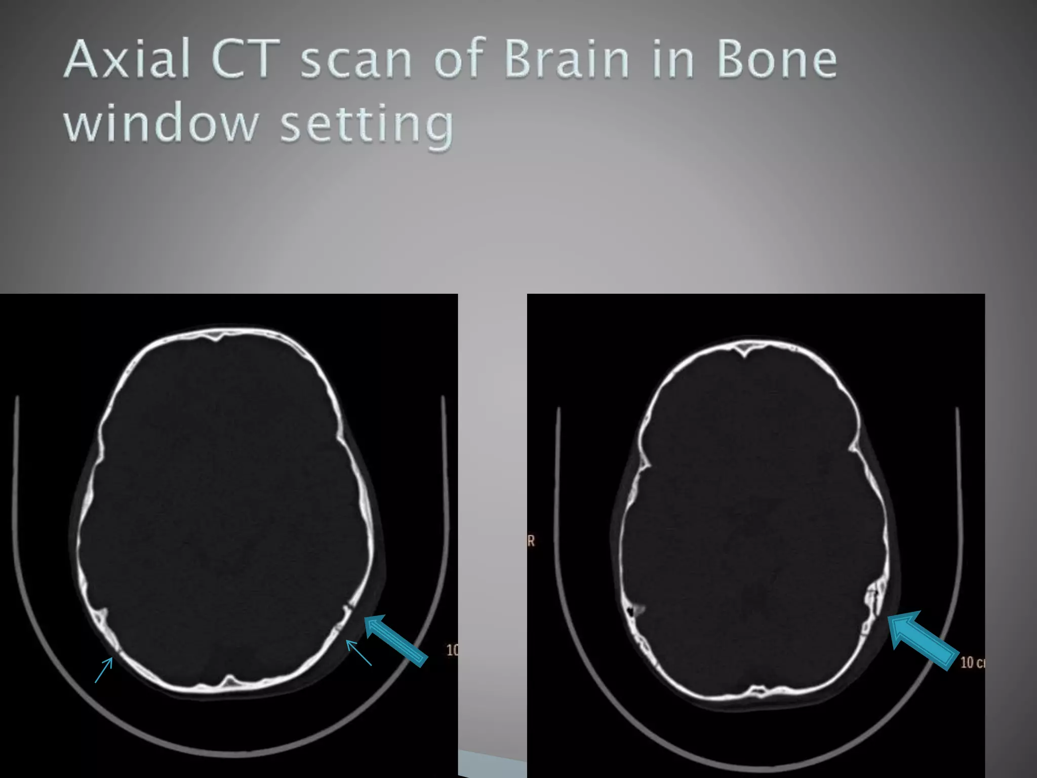 skull fractures vs accessory sutures | PPTX