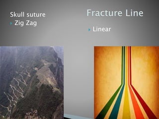 skull fractures vs accessory sutures | PPTX
