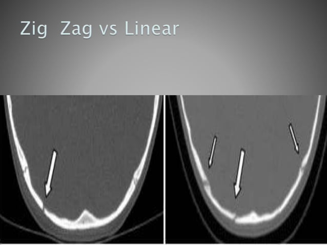 skull fractures vs accessory sutures | PPTX