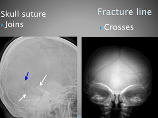 skull fractures vs accessory sutures | PPT