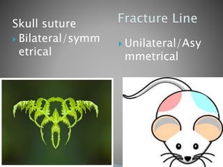 skull fractures vs accessory sutures | PPTX