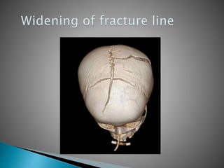 skull fractures vs accessory sutures | PPTX
