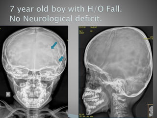 skull fractures vs accessory sutures | PPTX