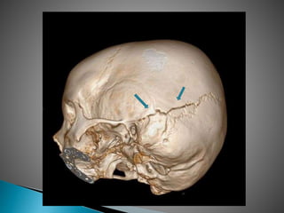 skull fractures vs accessory sutures | PPTX