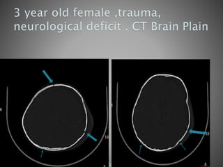 skull fractures vs accessory sutures | PPTX