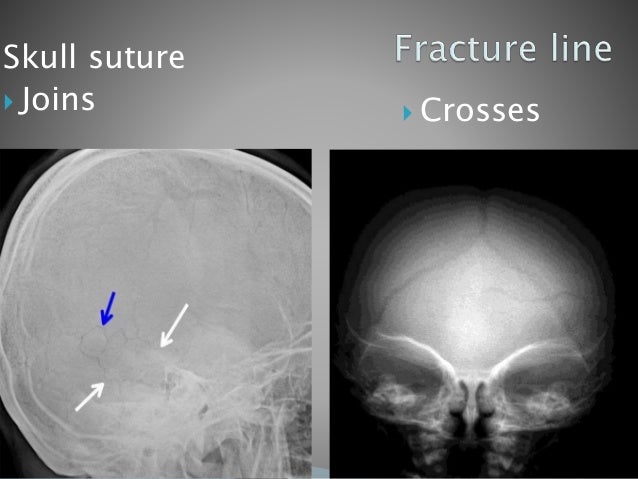 skull fractures vs accessory sutures
