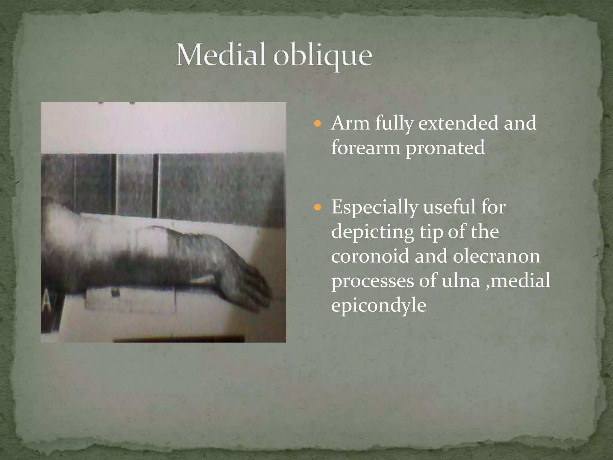 ELBOW JOINT X-RAY PROJECTIONS | PPTX