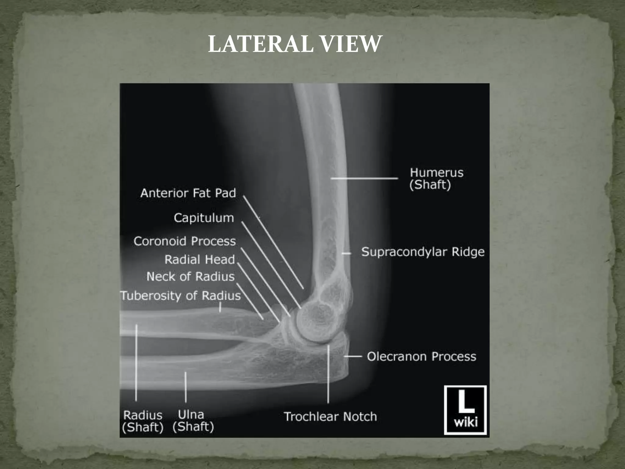 ELBOW JOINT X-RAY PROJECTIONS | PPTX