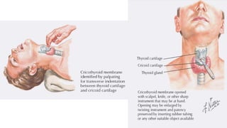 Normal Surface Anatomy of The Chest.pptx