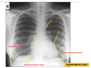 Surface anatomy of heart and lungs | PDF