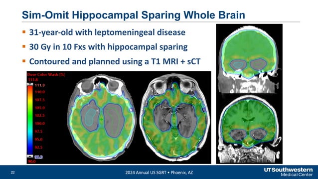 Surface Guidance Advancement Novel Usage of SGRT for CBCT-based ...