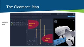 Surface Guided Planning for Breast Treatments | PDF