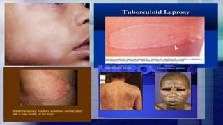 Surface infection | PPTX
