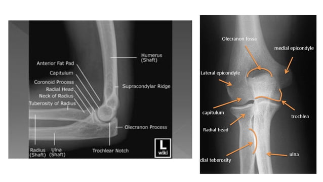 SURFACE MARKING & RADIOLOGY OF UPPER LIMB.pptx