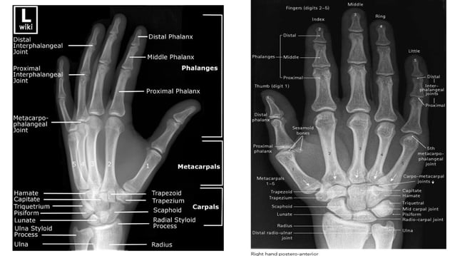 SURFACE MARKING & RADIOLOGY OF UPPER LIMB.pptx