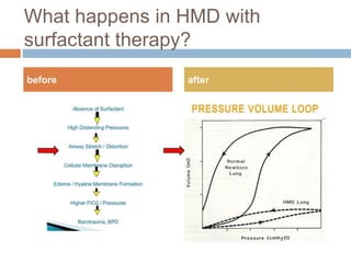 Surfactant in RDS | PPT