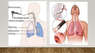 Surfactant therapy |medical administration of exogenous surfactant | PPTX