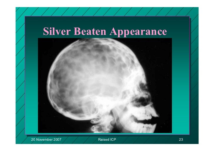 Surg351 presentation and management of raised intracranial pressure