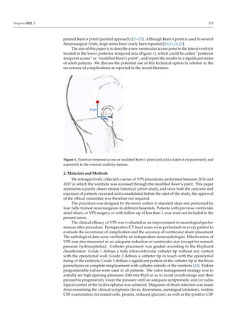 surgeries-03-00034 vp shunt surgery using modified keens point ...