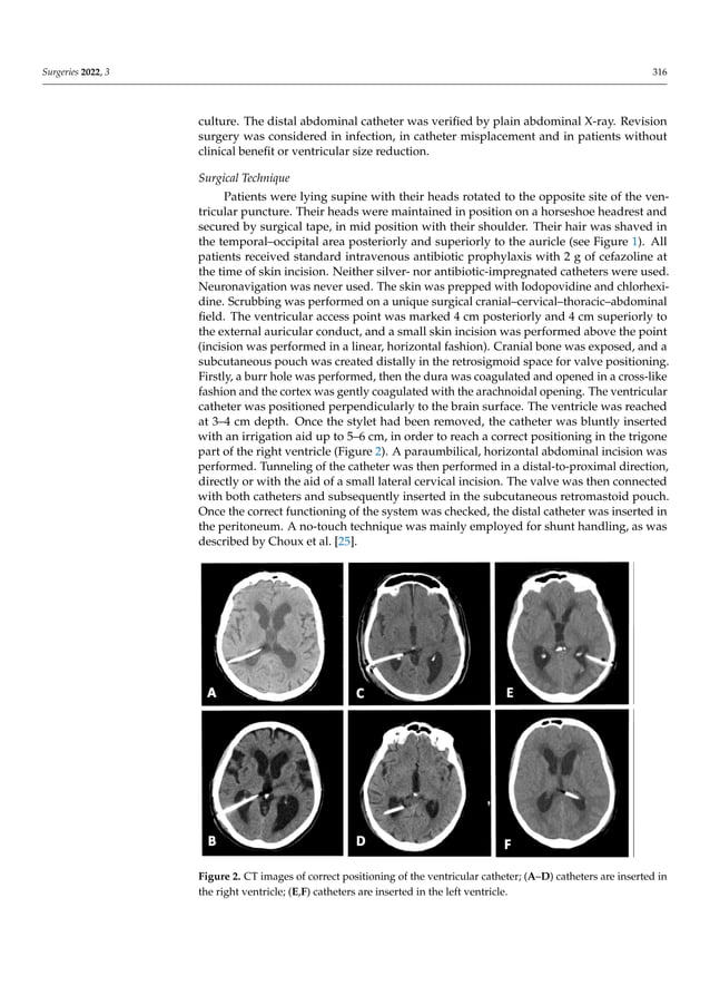 surgeries-03-00034 vp shunt surgery using modified keens point ...