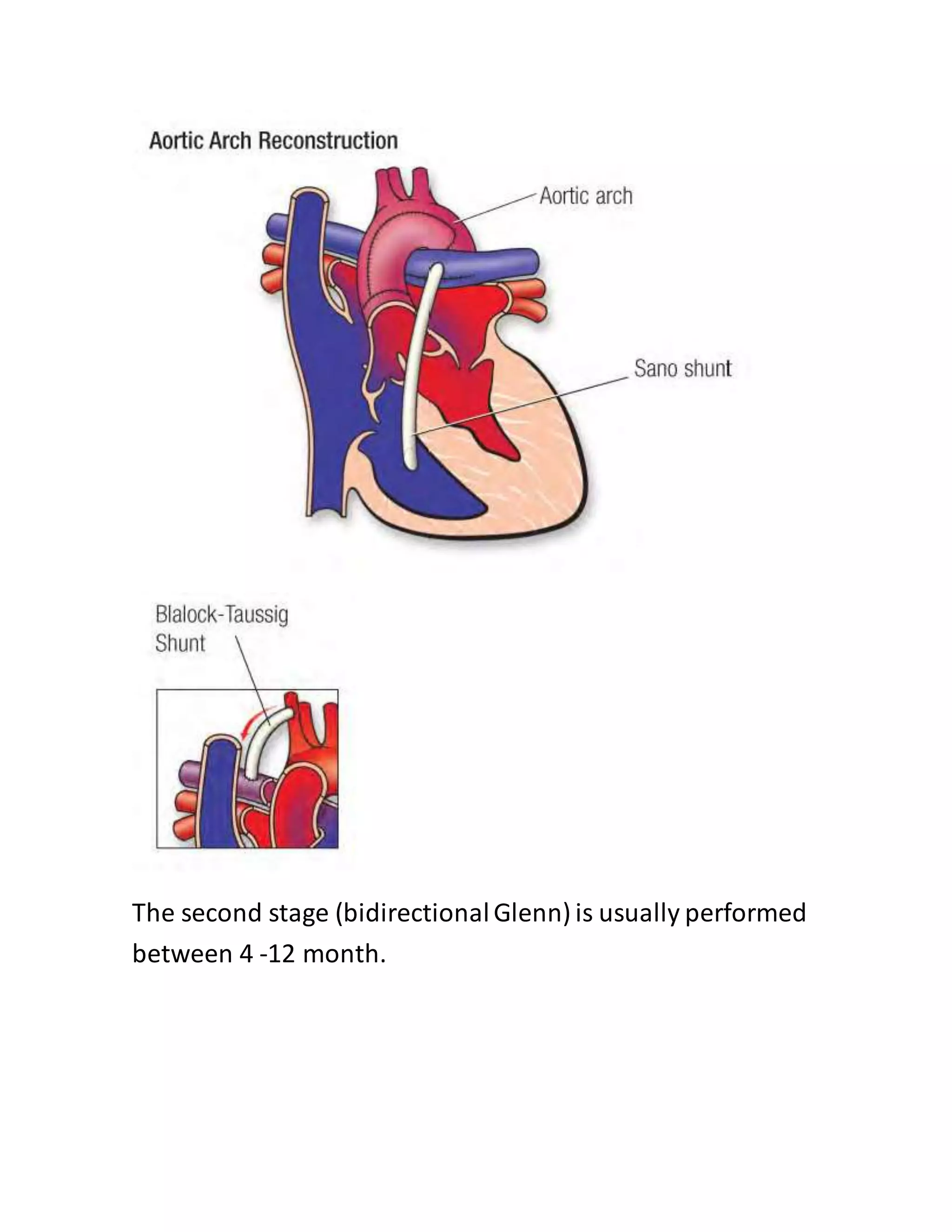 Surgeries for complex congenital heart disease | DOCX