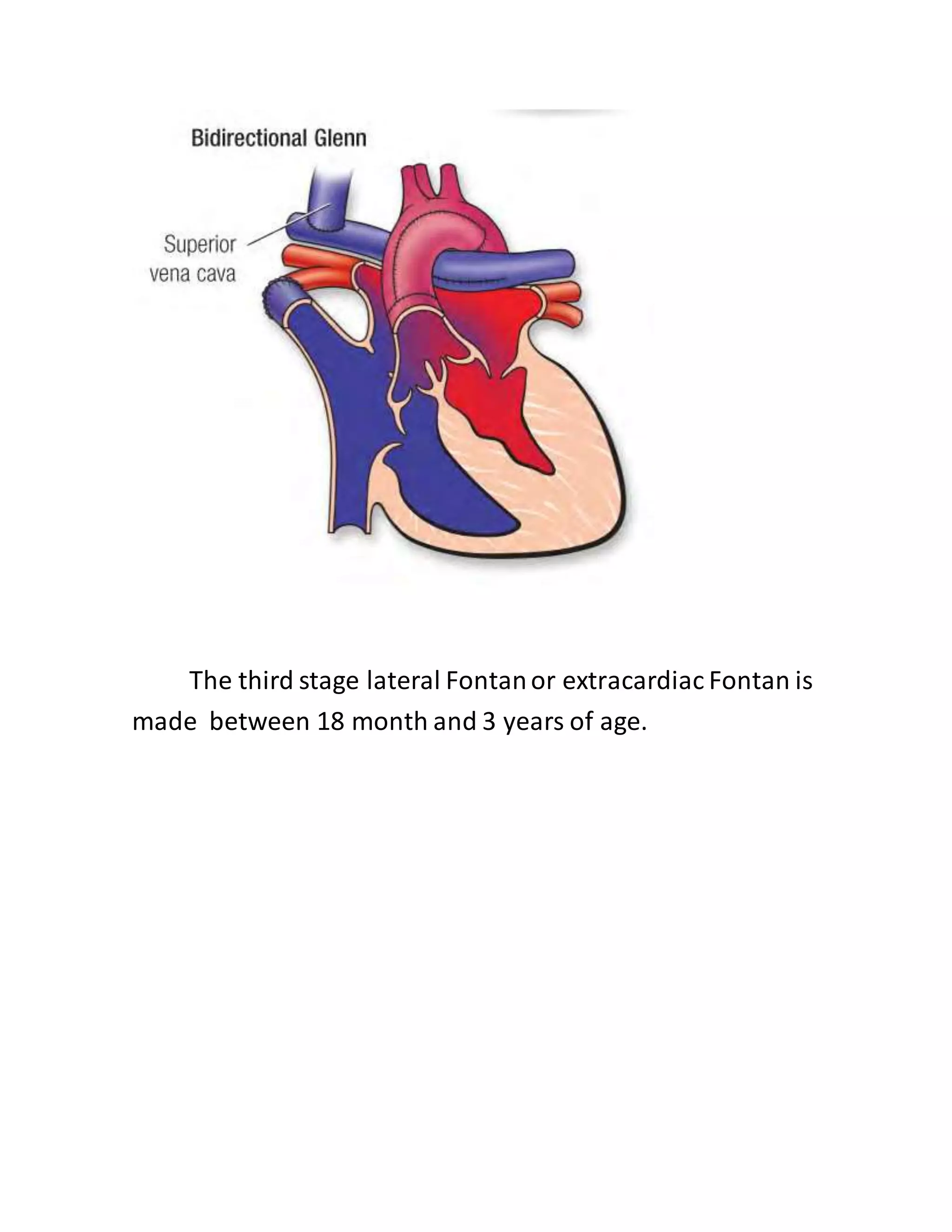 Surgeries for complex congenital heart disease | DOCX