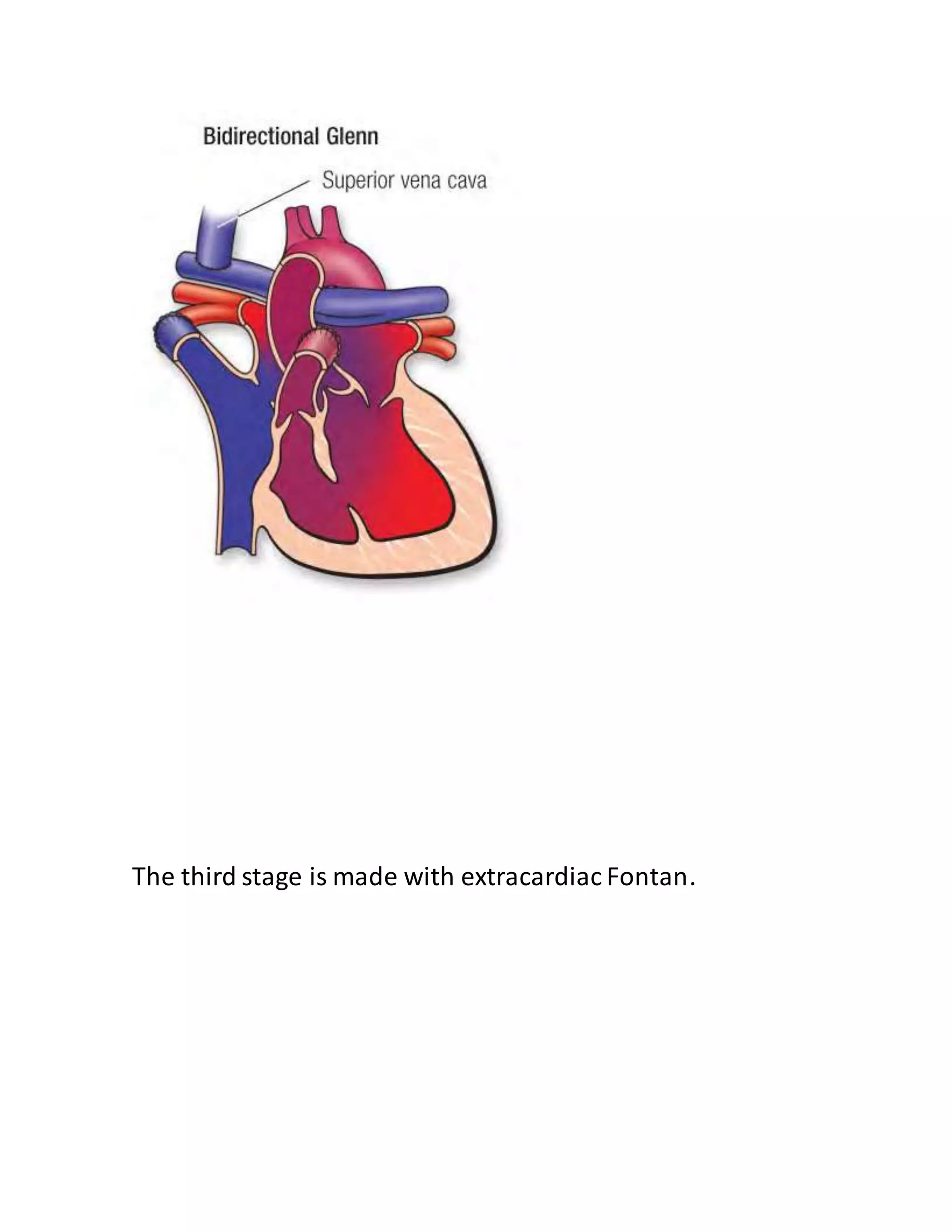 Surgeries for complex congenital heart disease | DOCX