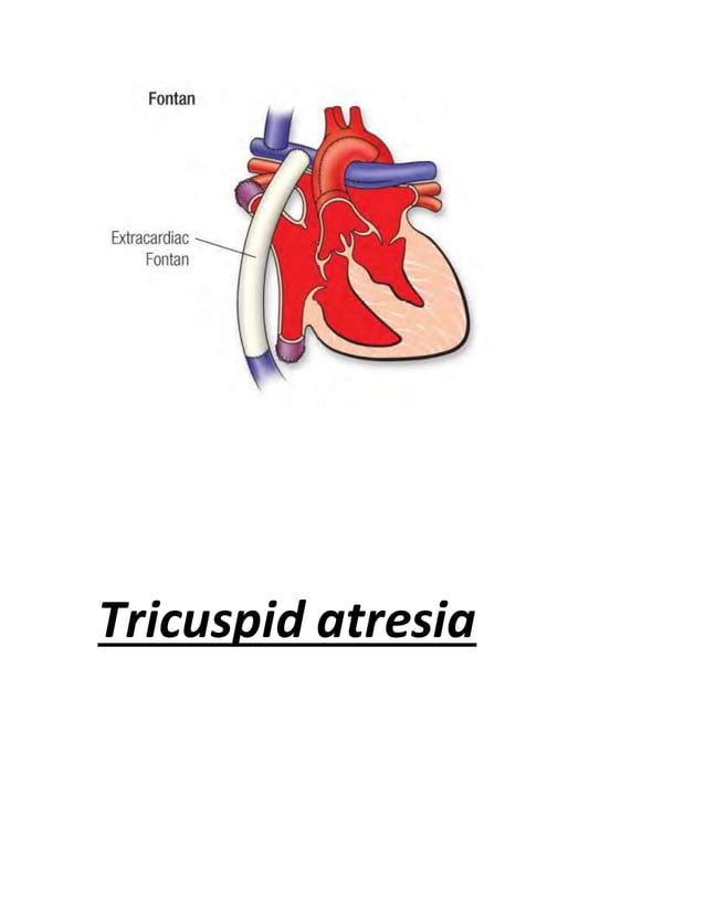Surgeries for complex congenital heart disease | DOCX