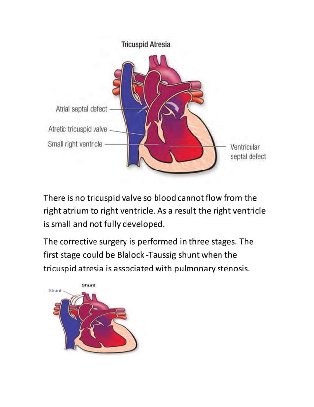 Surgeries for complex congenital heart disease | DOCX