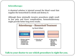 Types of Surgeries for piles | PPTX | First Aid | Injuries