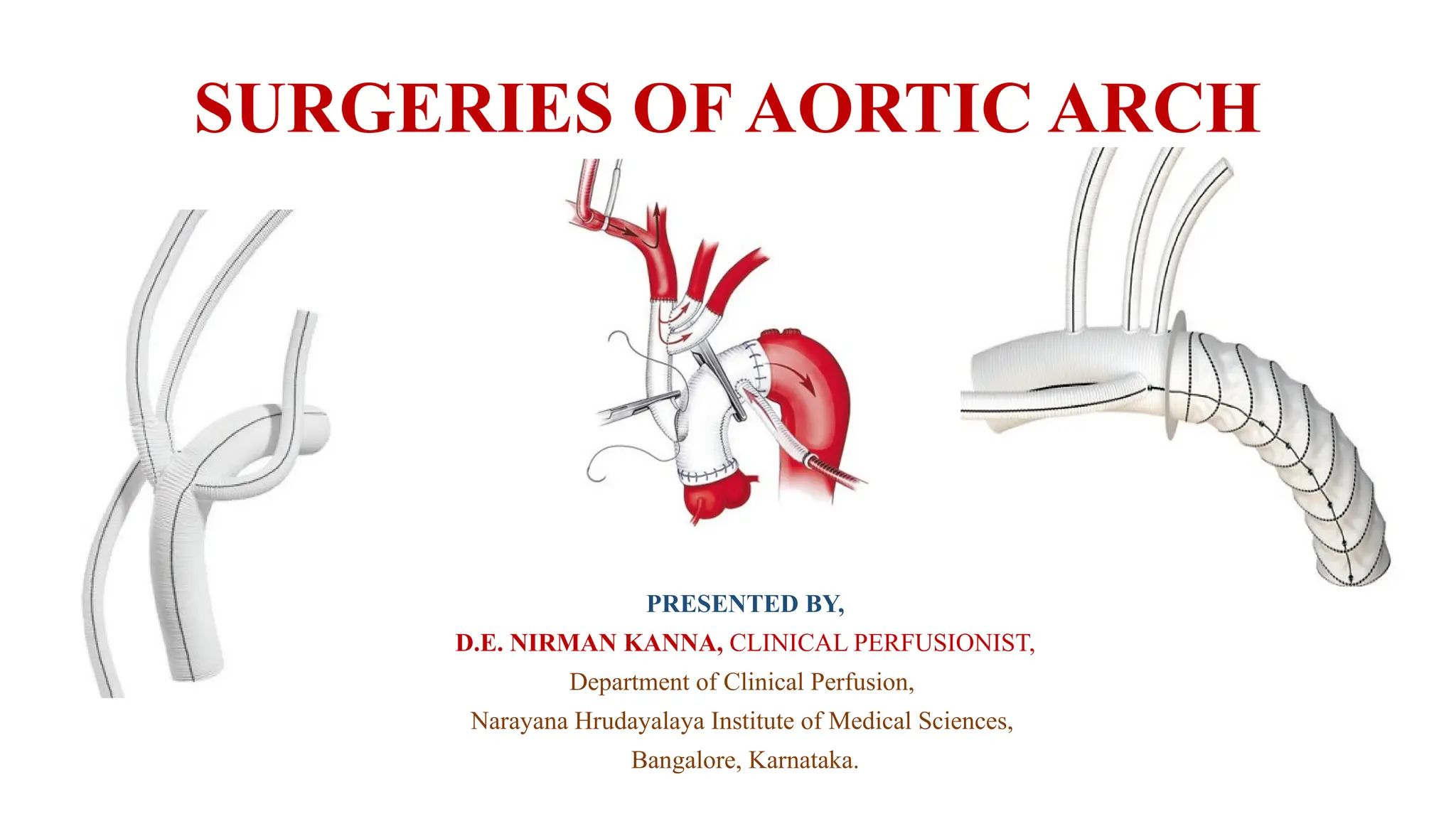 SURGICAL MANAGEMENT OF AORTIC ARCH PATHOLOGY | PPTX