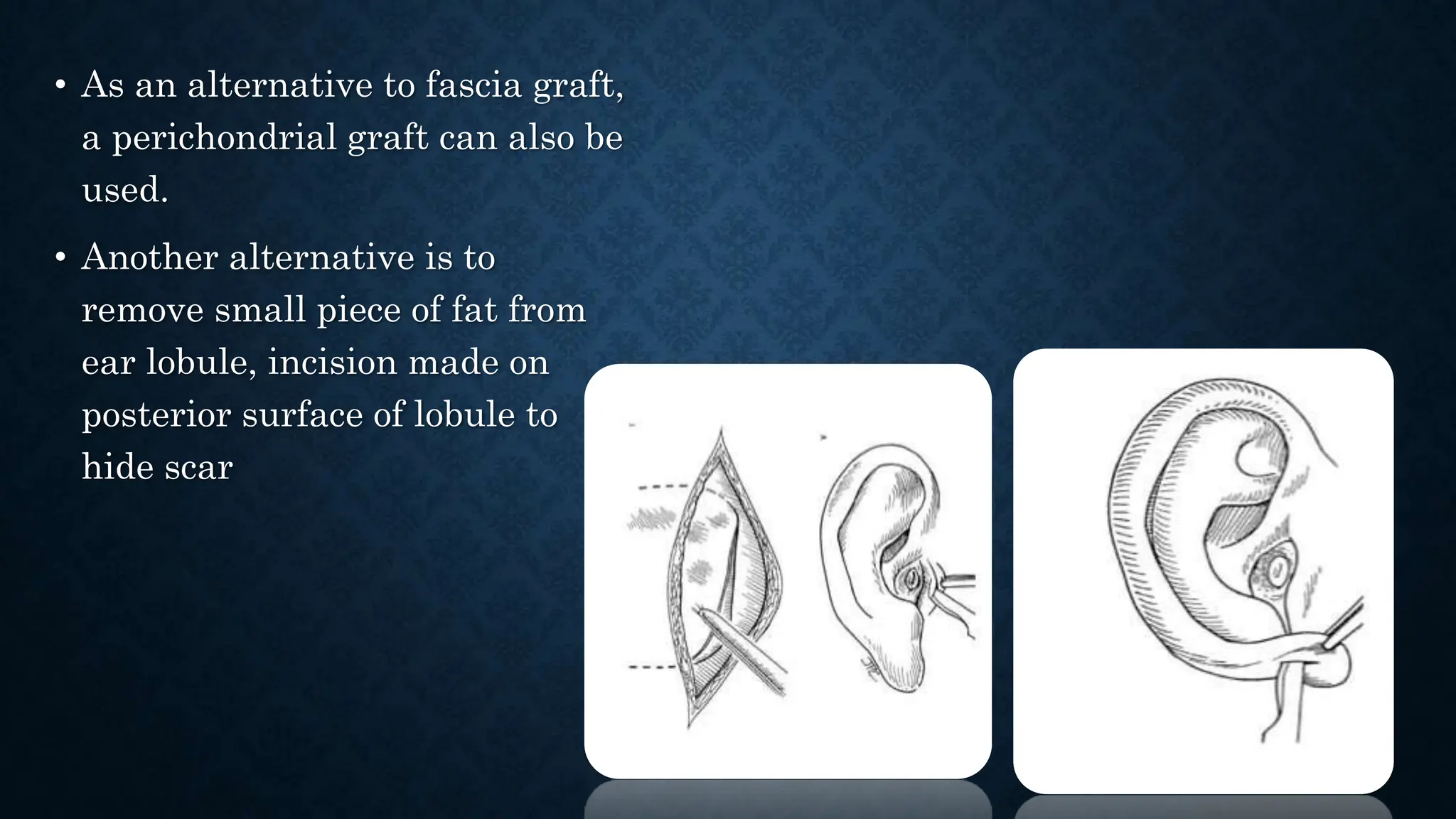 surgeries of ear.pptx
