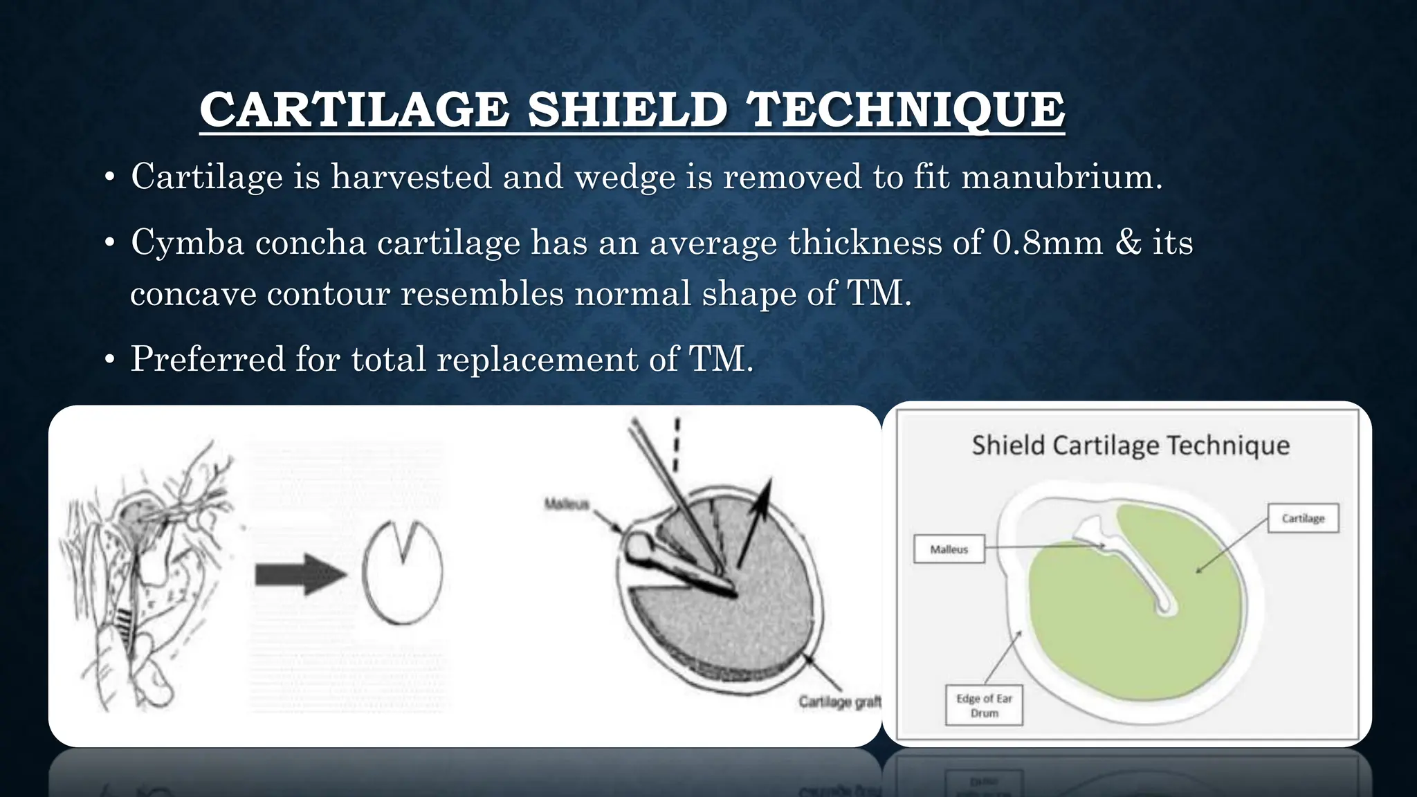 surgeries of ear.pptx