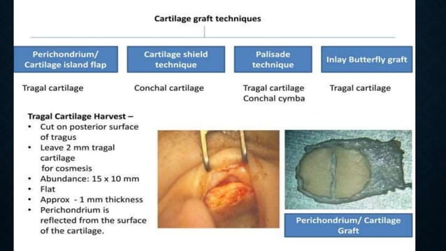 surgeries of ear.pptx