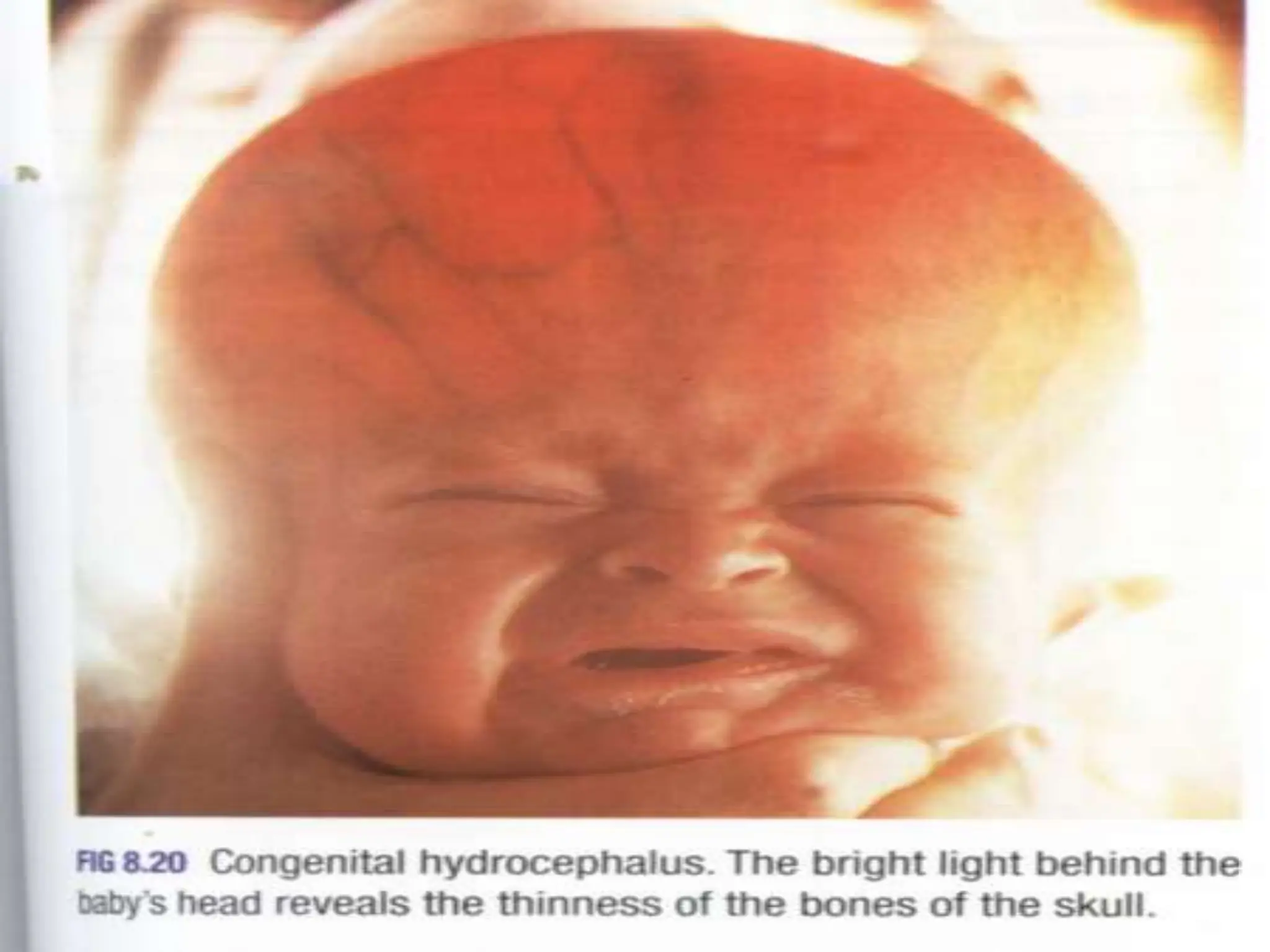 Surgeri II 03 Hidrosefalus in surgey (1 jam).ppt