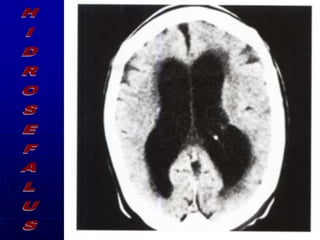 Surgeri II 03 Hidrosefalus in surgey (1 jam).ppt