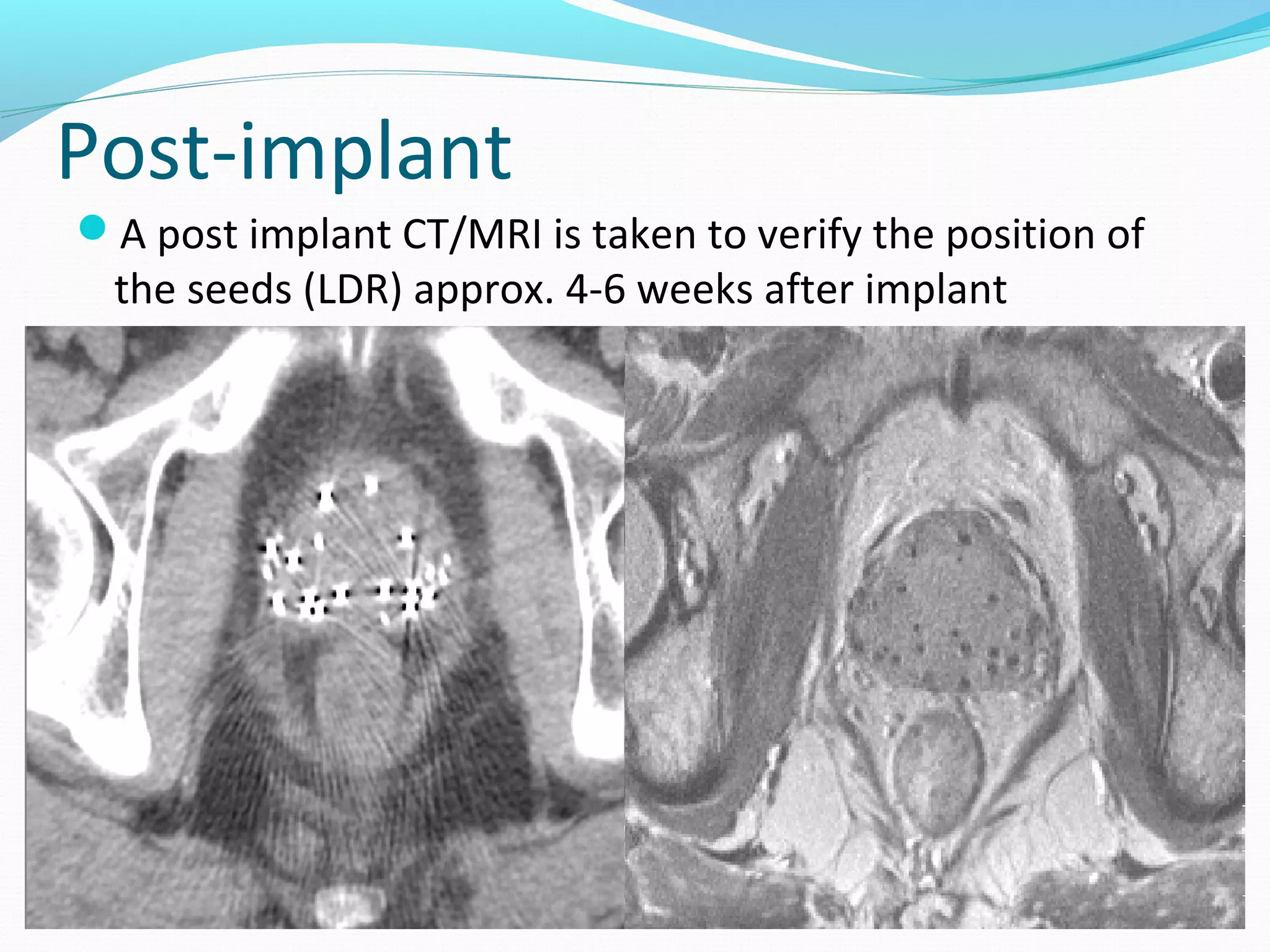 Radical Prostate Radiotherapy | PPT