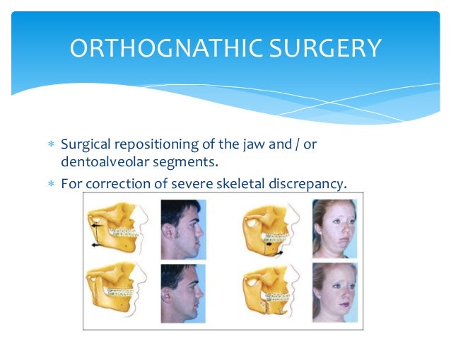 Pre-Surgical procedures in orthognathic surgeries of mandible.