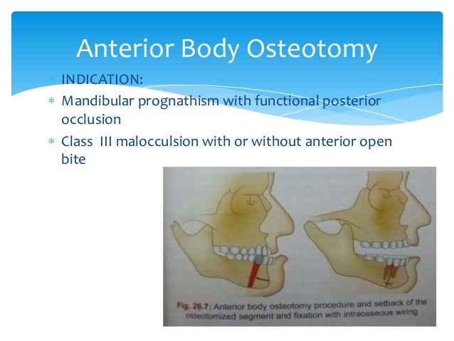 Pre-Surgical procedures in orthognathic surgeries of mandible.