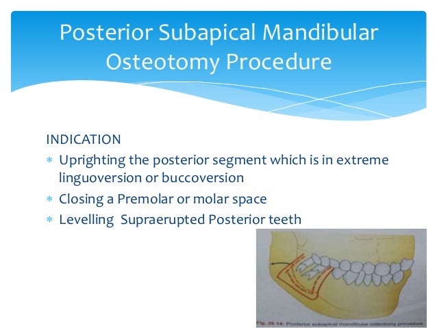 Pre-Surgical procedures in orthognathic surgeries of mandible.
